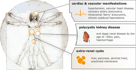 What Causes Cyst Formation In Polycystic Kidney Disease? | Kidney Coach